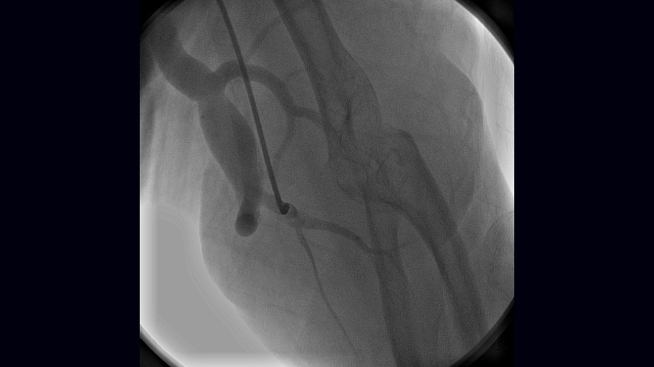 Arteriovenous Fistula for Hemodialysis Complicated by a Giant Venous ...
