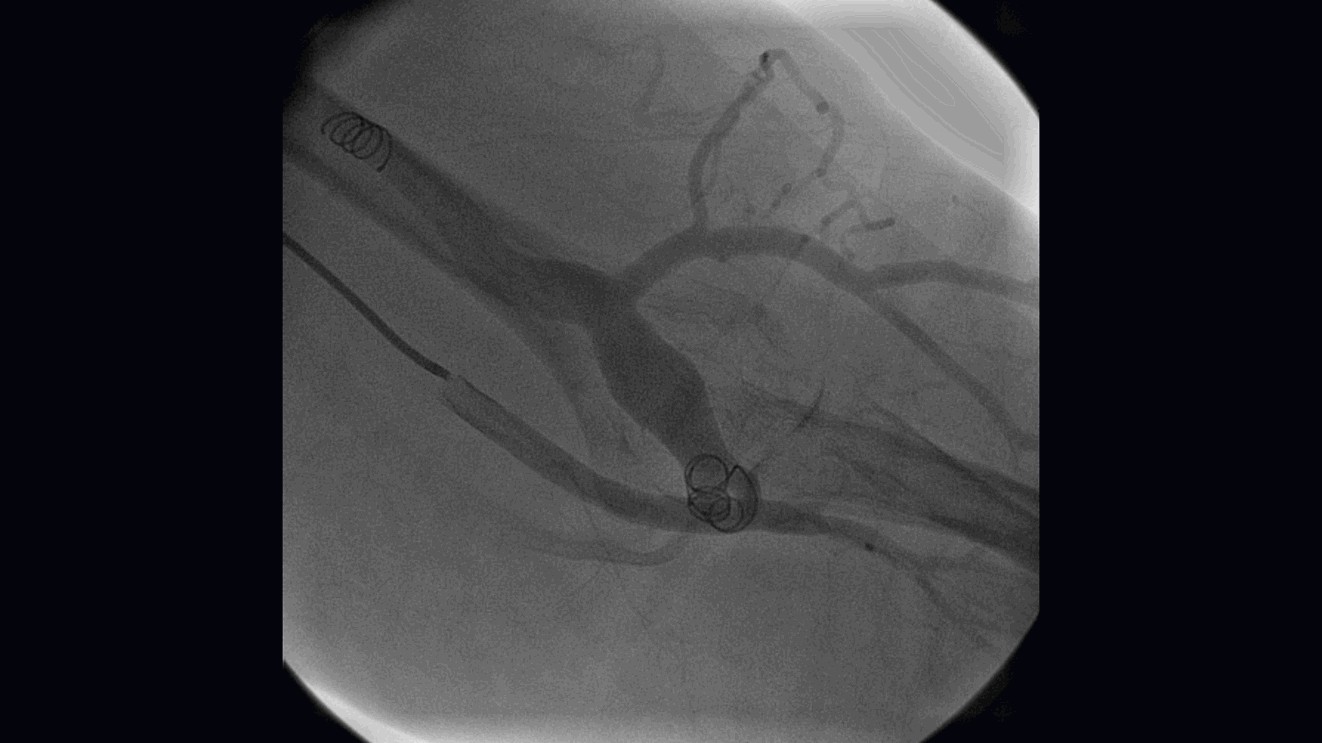 Arteriovenous Fistula for Hemodialysis Complicated by a Giant Venous ...
