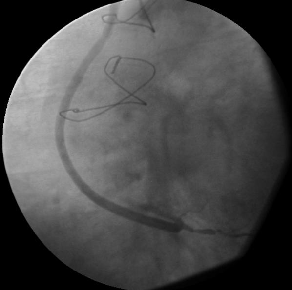 Protected Distal LMCA Crush Stenting | tctmd.com