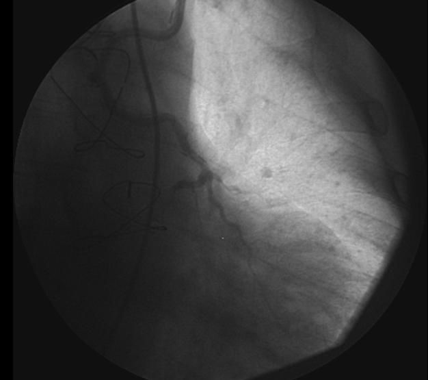 Protected Distal LMCA Crush Stenting | tctmd.com