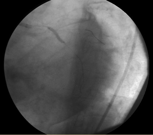 Protected Distal LMCA Crush Stenting | tctmd.com