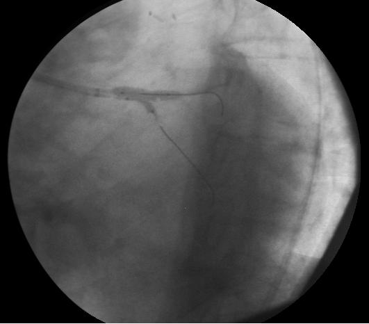 Protected Distal LMCA Crush Stenting | tctmd.com