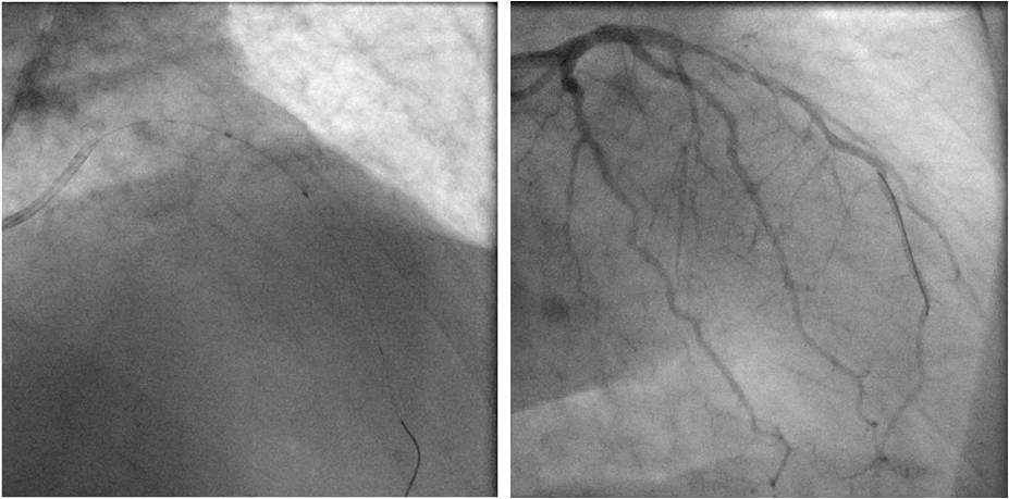 Bilateral Thrombotic Occlusion in STEMI: Staged Approach with Self-Expanding Stent | tctmd.com