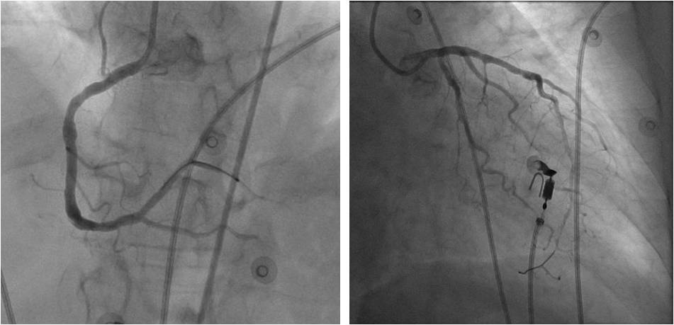 Bilateral Thrombotic Occlusion in STEMI: Staged Approach with Self-Expanding Stent | tctmd.com