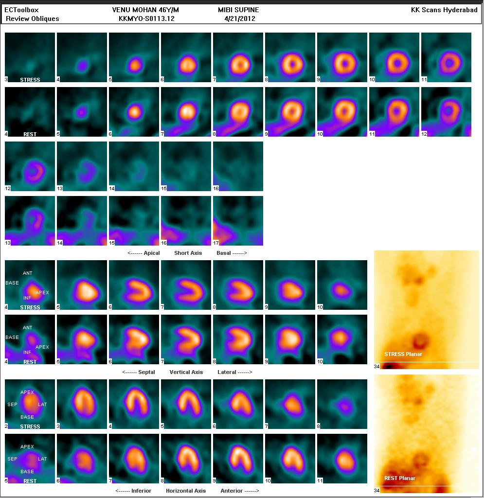 FFR is the Only Way to Decide When Treating in Multivessel CAD in ACS ...