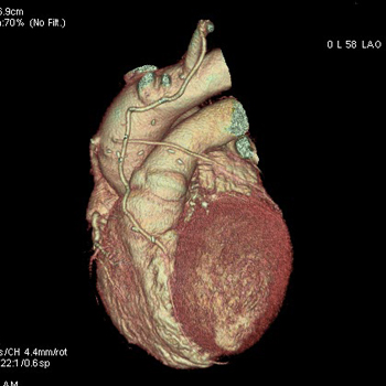 LIMA Stenting Through a Left Radial Approach After PCI of an LAD ...