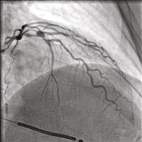 Double Bifurcation Treated with Two Tryton Side-Branch Stents | tctmd.com