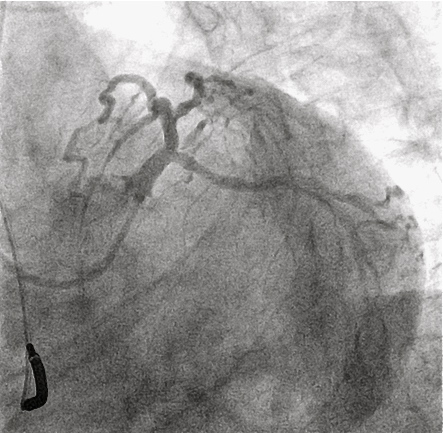 Double Bifurcation Treated with Two Tryton Side-Branch Stents | tctmd.com