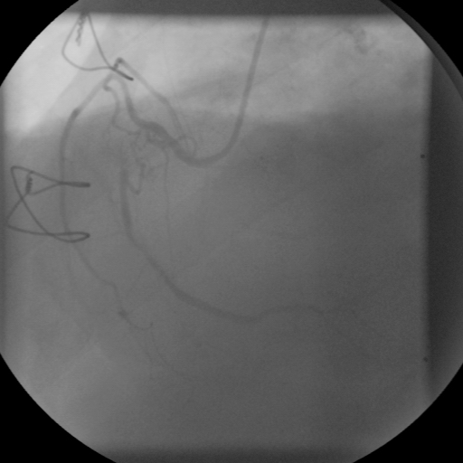 Distal Embolic Protection in SVG Intervention | tctmd.com