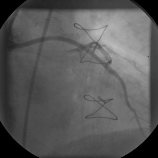 Distal Embolic Protection in SVG Intervention | tctmd.com