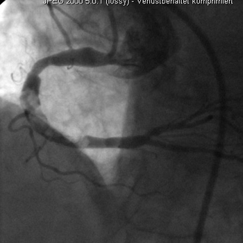 How Should I Treat a Transient STEMI Caused by a Very Late Massive ...