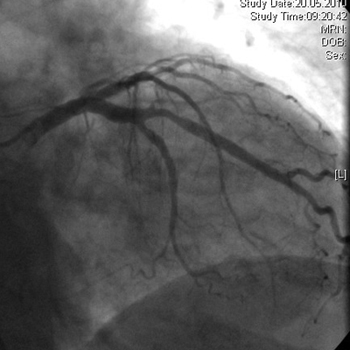 How Should I Treat a Transient STEMI Caused by a Very Late Massive ...